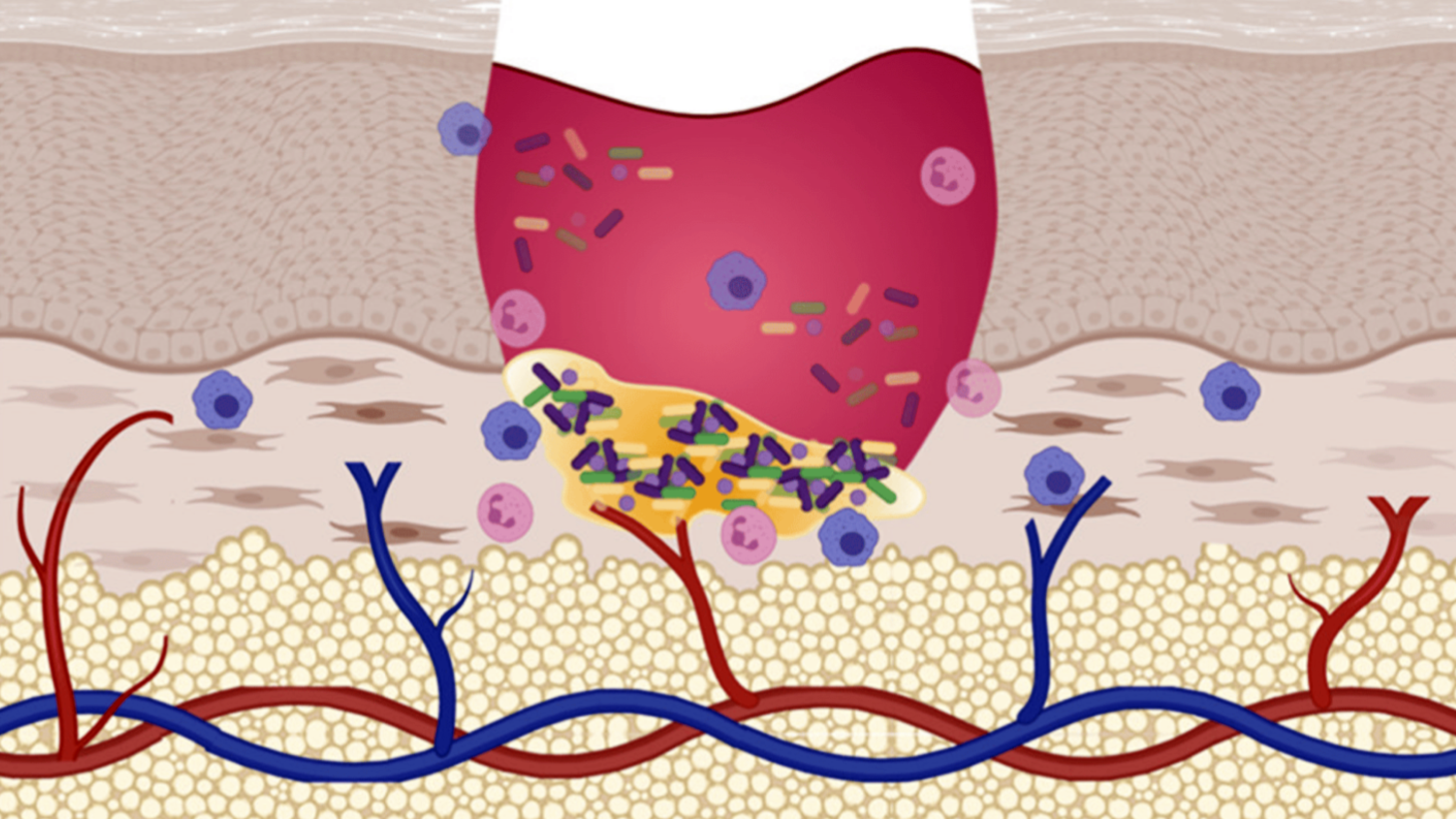 Postintervention monitoring of peripheral arterial disease wound ...