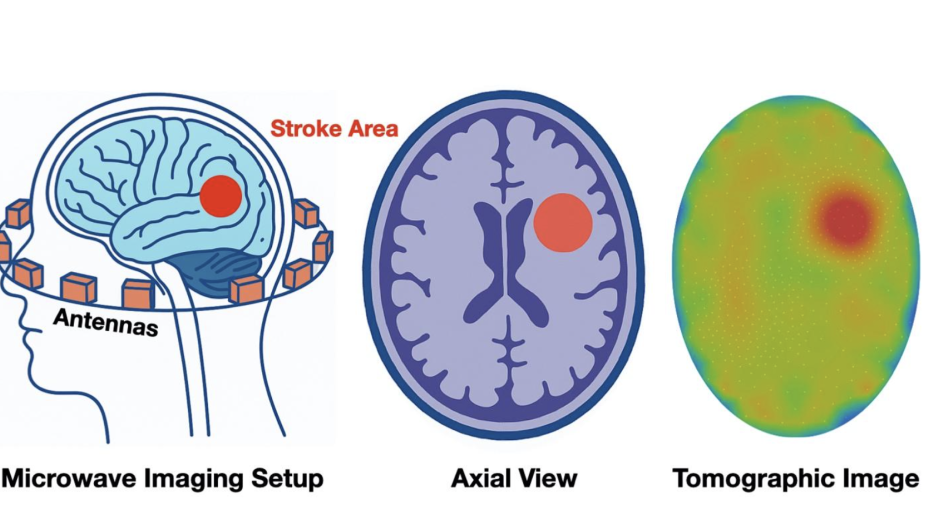 New Algorithm Dramatically Speeds Up Stroke Detection Scans | NYU ...