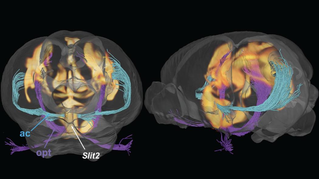 Ultrafast MRI Diffusion Tensor Imaging for High Resolution Brain ...
