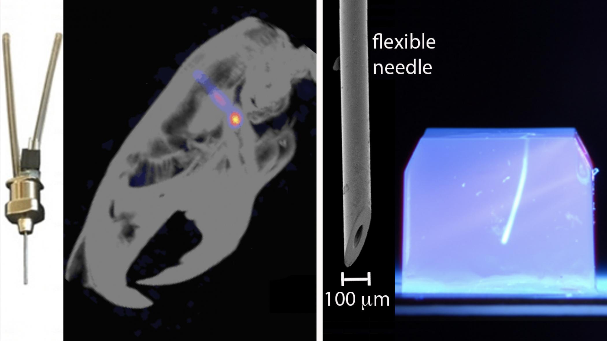 Minimally invasive technologies for neuromodulation in treatment of ...